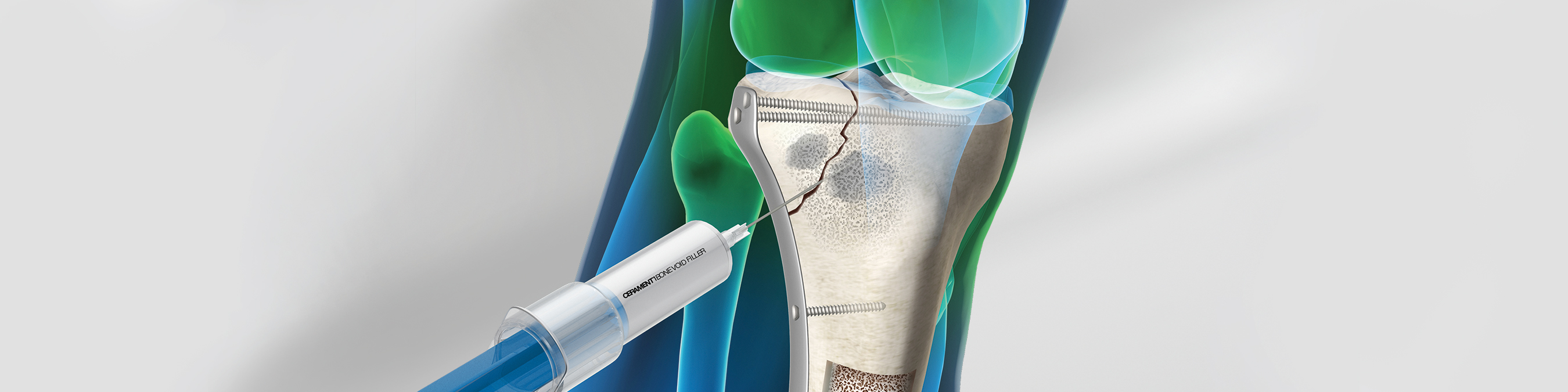 Bone Grafting | CERAMENT™ | BONE VOID FILLER | Zimmer Biomet