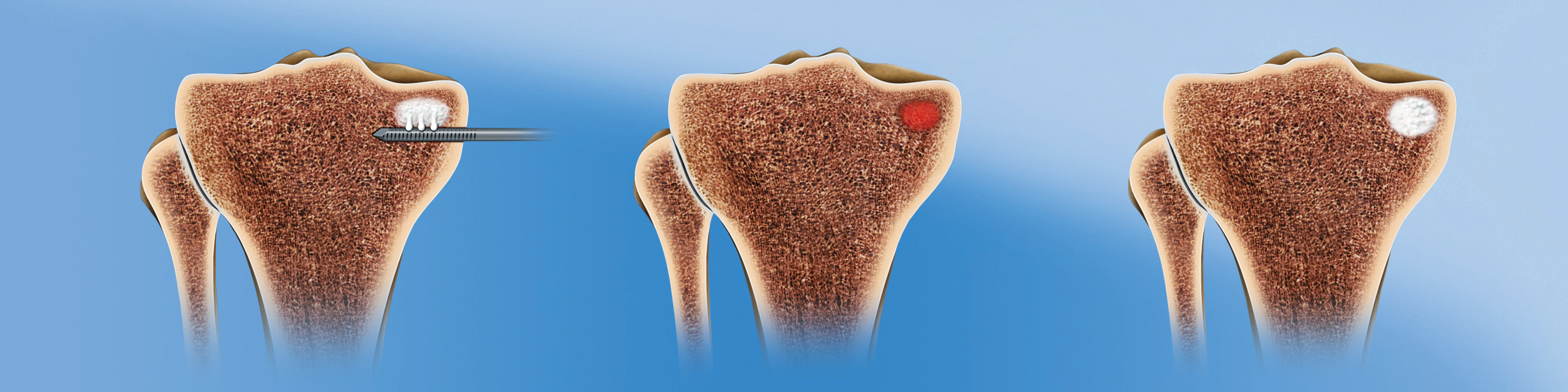 The Subchondroplasty®(SCP®) Procedure